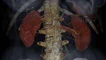 Global Kidney Academy: CKD-Associated Pruritus (CKD-aP)